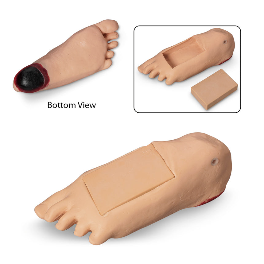Life/form® GERi and KERi Optional Edema Foot with Deep Tissue Injury ...