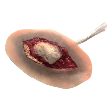 Open Ankle Dislocation – MedTech